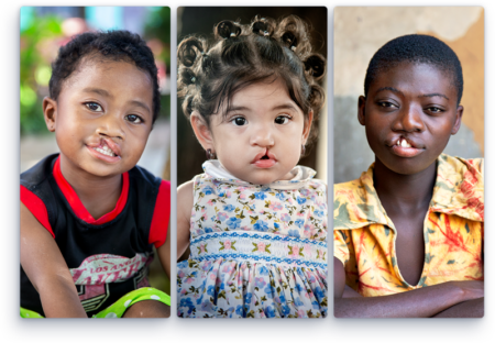 Operation Smile Canada - Every child with a cleft lip or cleft palate ...