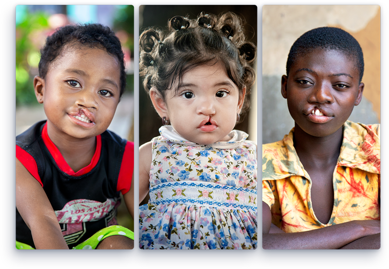 Operation Smile Canada - Every child with a cleft lip or cleft palate ...