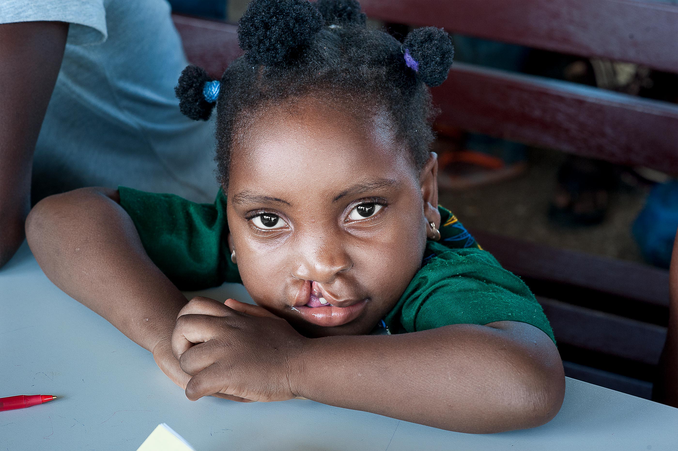 The road to Ramata's smile - Operation Smile Canada